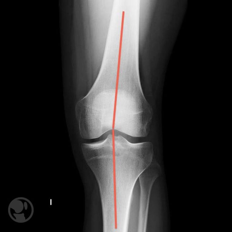 ¿Qué es la inestabilidad rotuliana? - aware.doctor
