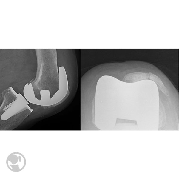 Descubre las clasificaciones y el algoritmo de las fracturas ...