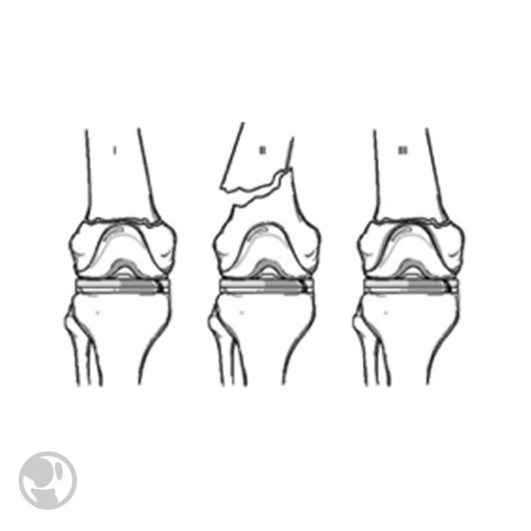 ¿Qué sabes acerca de las fracturas periprotésicas de femur? - aware.doctor