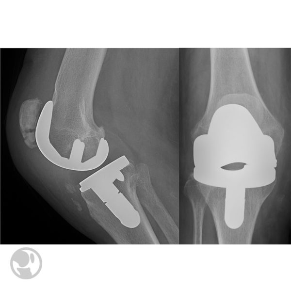 Descubre las clasificaciones y el algoritmo de las fracturas ...
