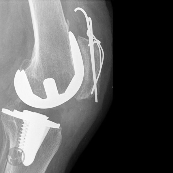 Descubre las clasificaciones y el algoritmo de las fracturas ...
